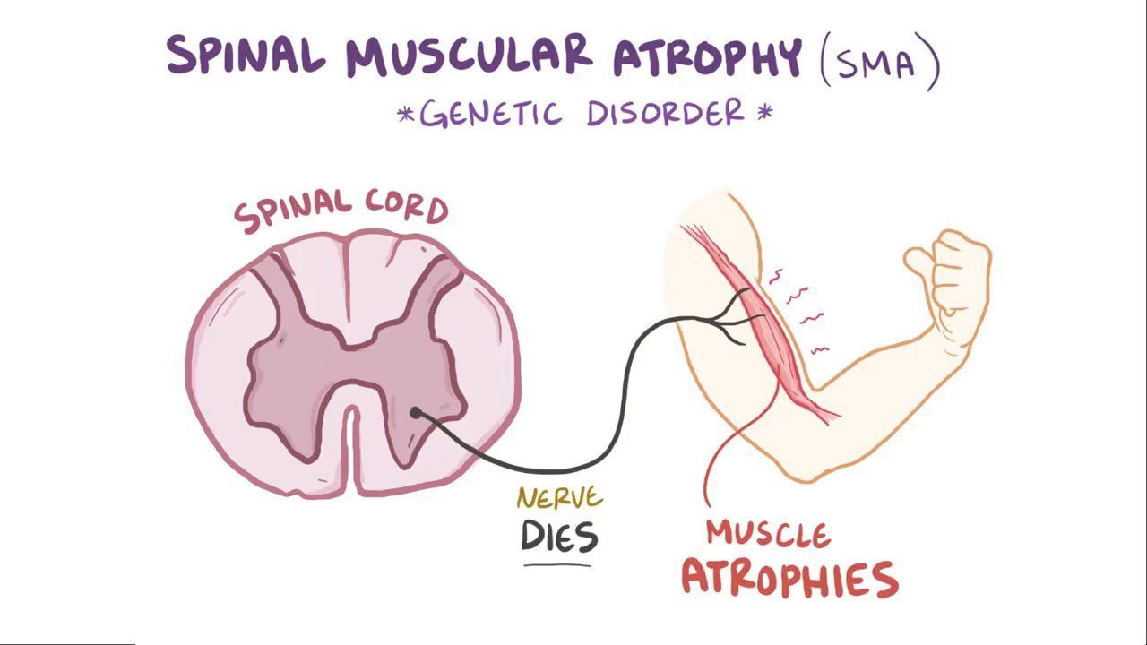 Video Spinal Muscular Atrophy Osmosis Video Spinal Muscular Atrophy Osmosis