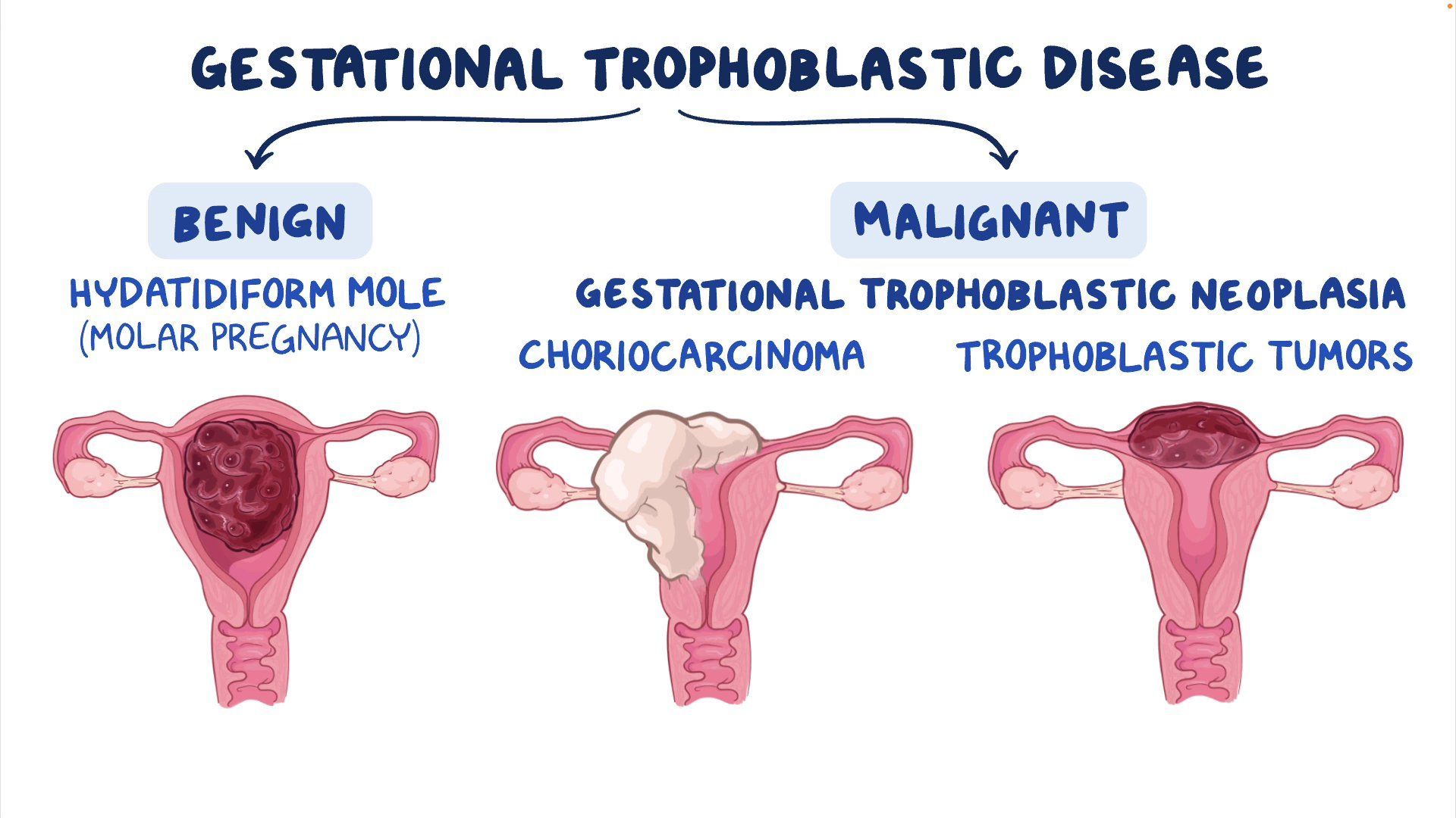 Video Gestational Trophoblastic Disease Nursing Osmosis Video Gestational Trophoblastic Disease Nursing Osmosis