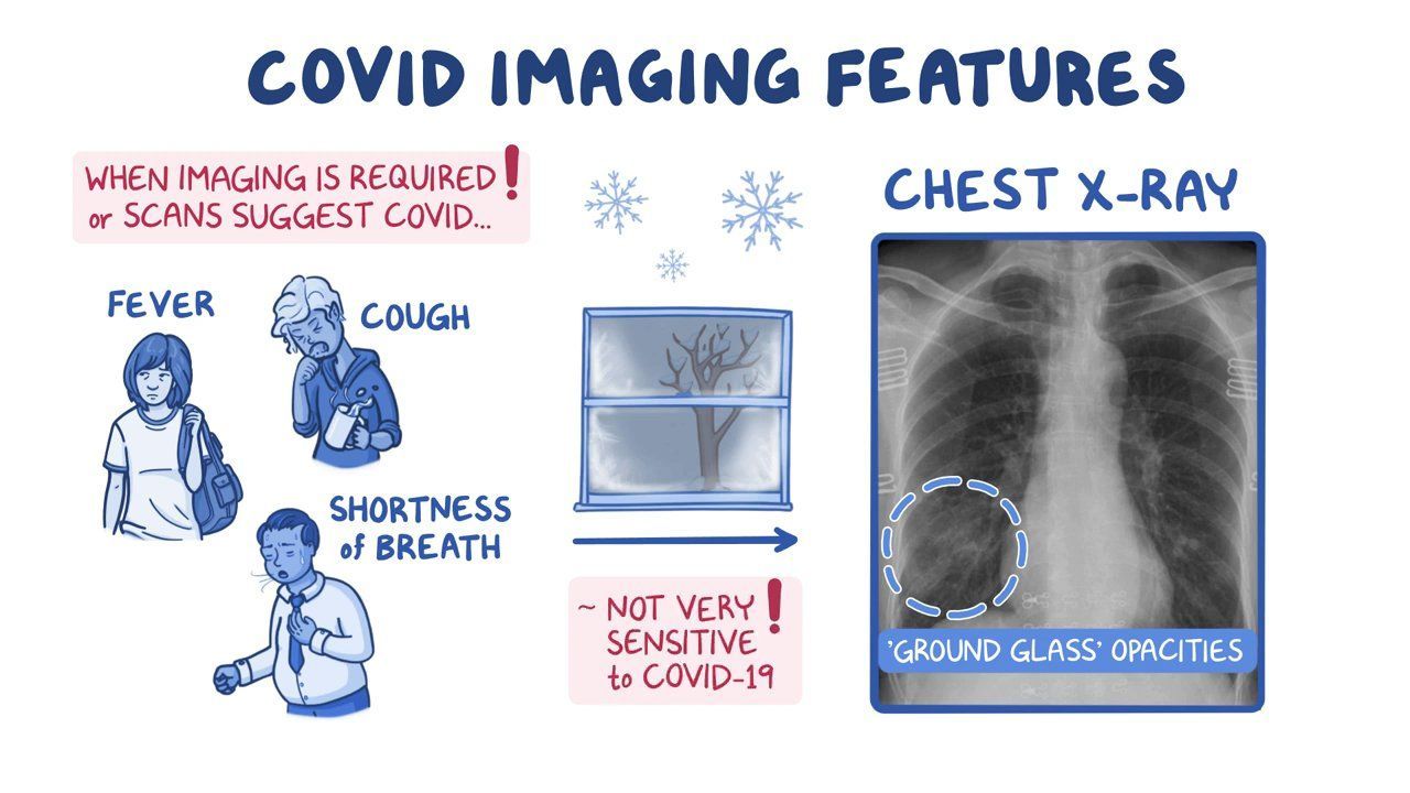 Video: Imaging features of COVID-19 (LifeBridge Health) | Osmosis