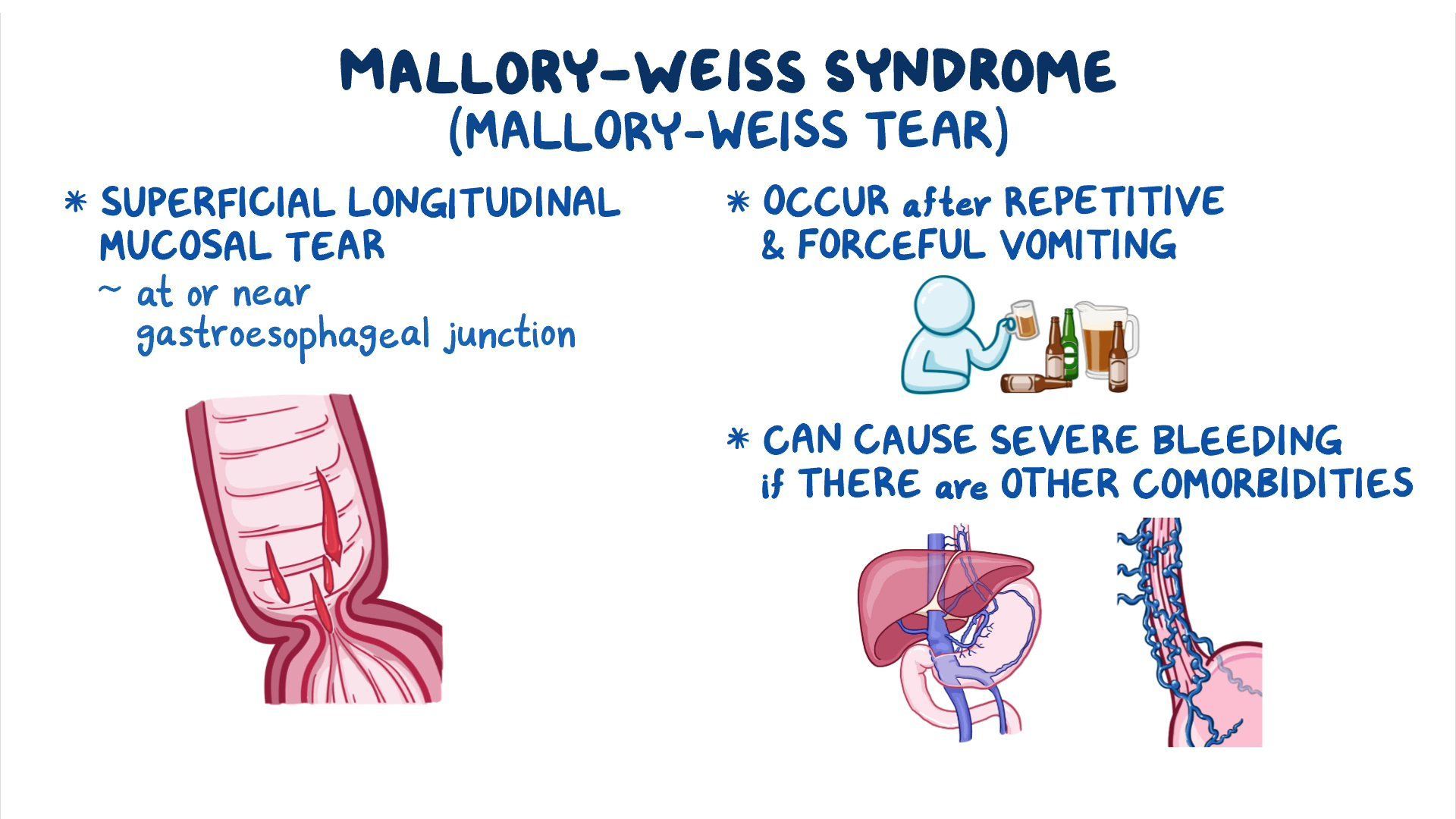 Video: Mallory-Weiss syndrome: Clinical sciences | Osmosis