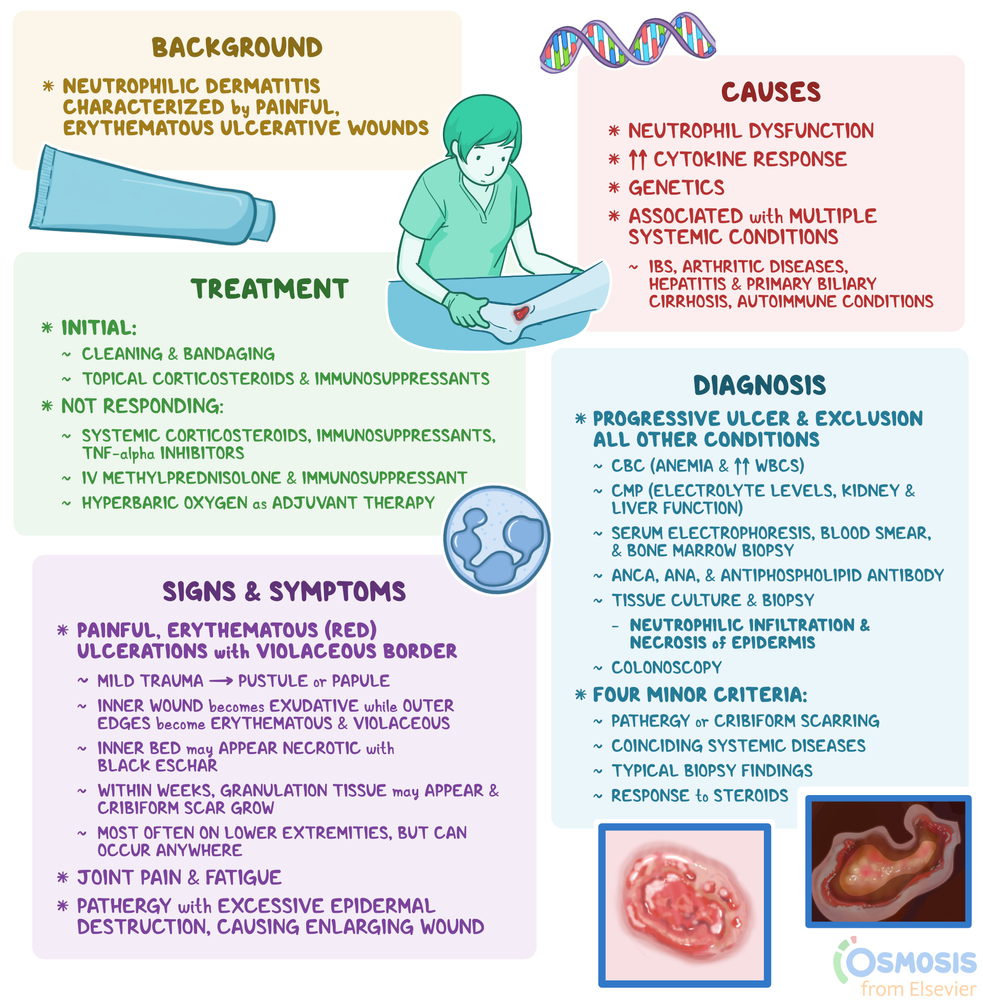 Pyoderma Gangrenosum: What It Is, Causes, Signs, Symptoms | Osmosis