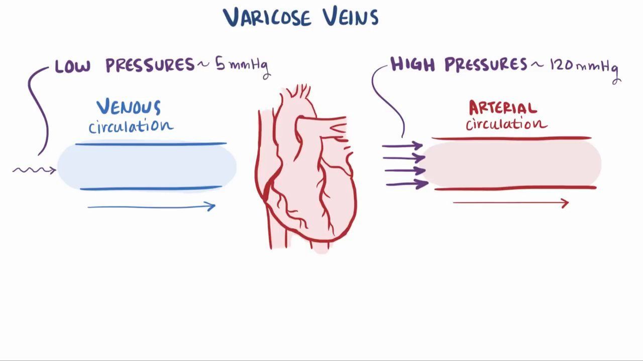 Video: Chronic venous insufficiency | Osmosis