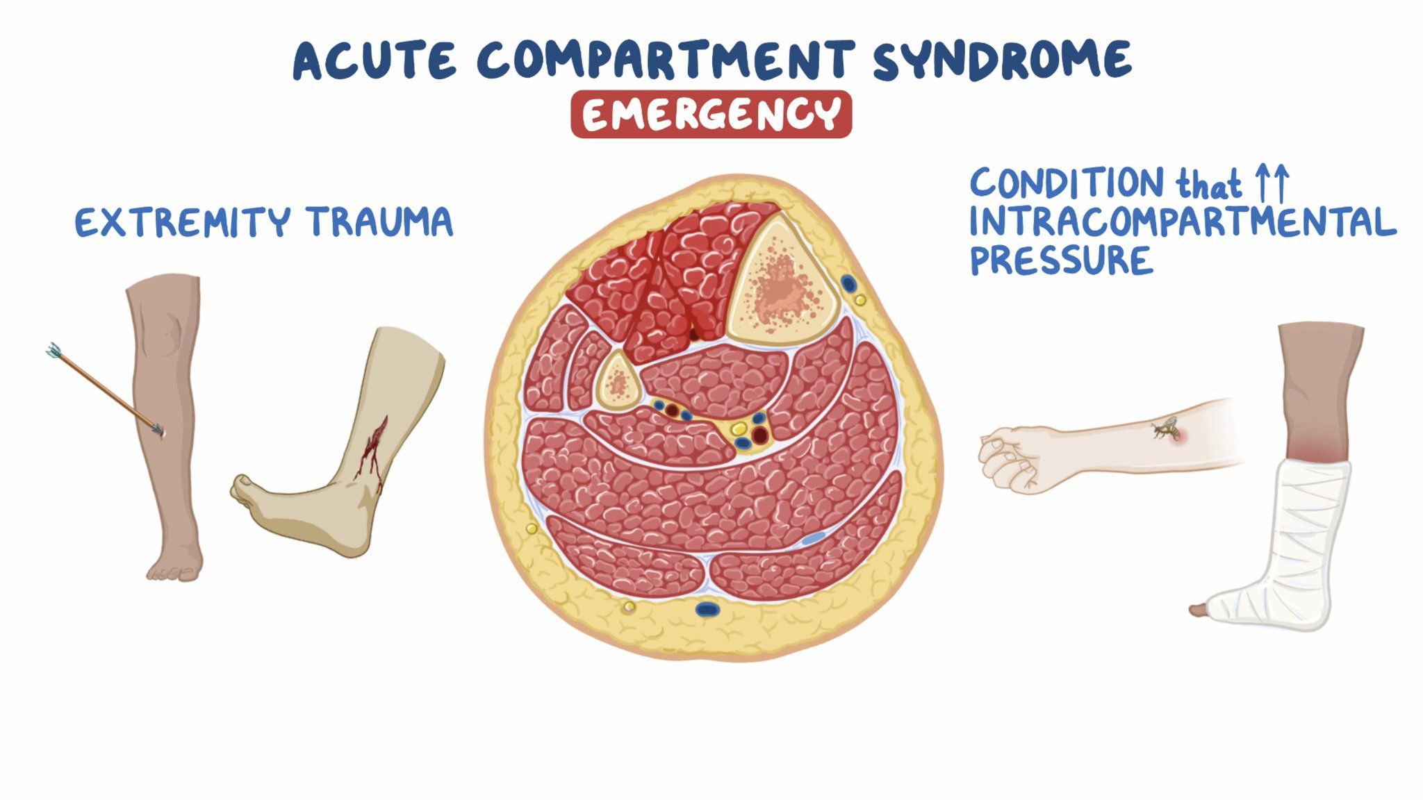 Video Compartment Syndrome Clinical Sciences