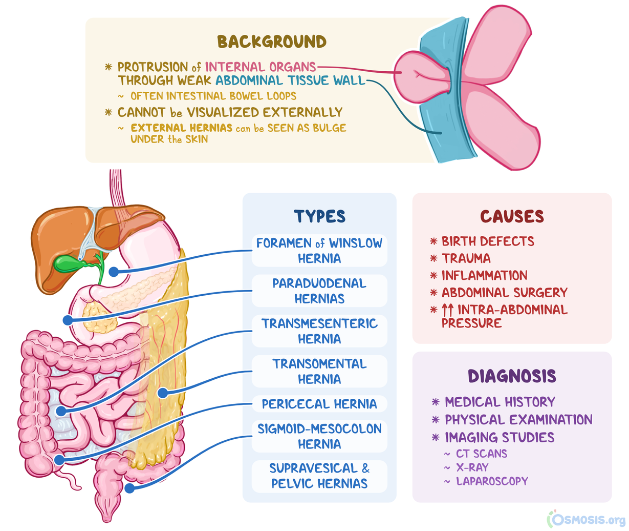 Internal Hernia What Is It Rupture Causes Symptoms Diagnosis Internal Hernia What Is It Rupture Causes Symptoms Diagnosis