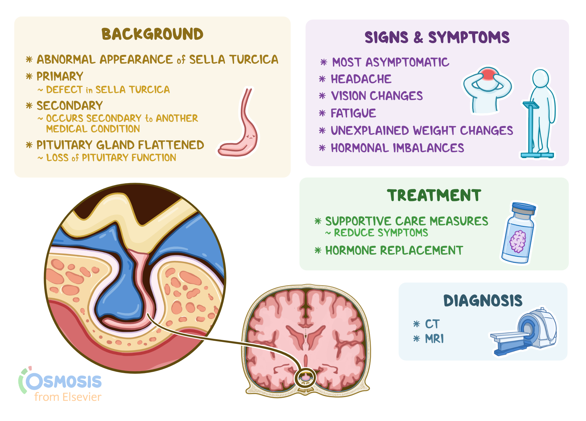 Empty Sella Syndrome: What It Is, Causes, Signs and Symptoms | Osmosis