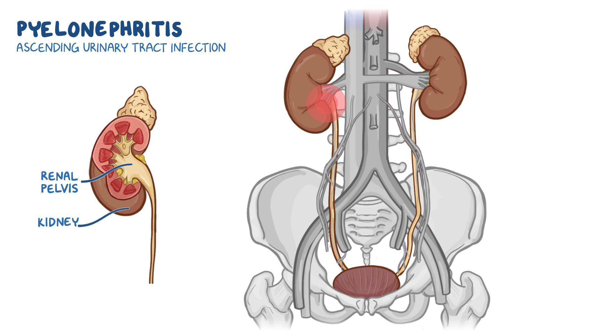 Video: Pyelonephritis: Nursing