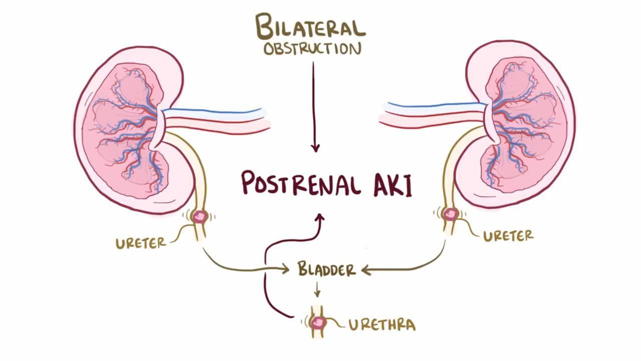 Video: Postrenal azotemia | Osmosis