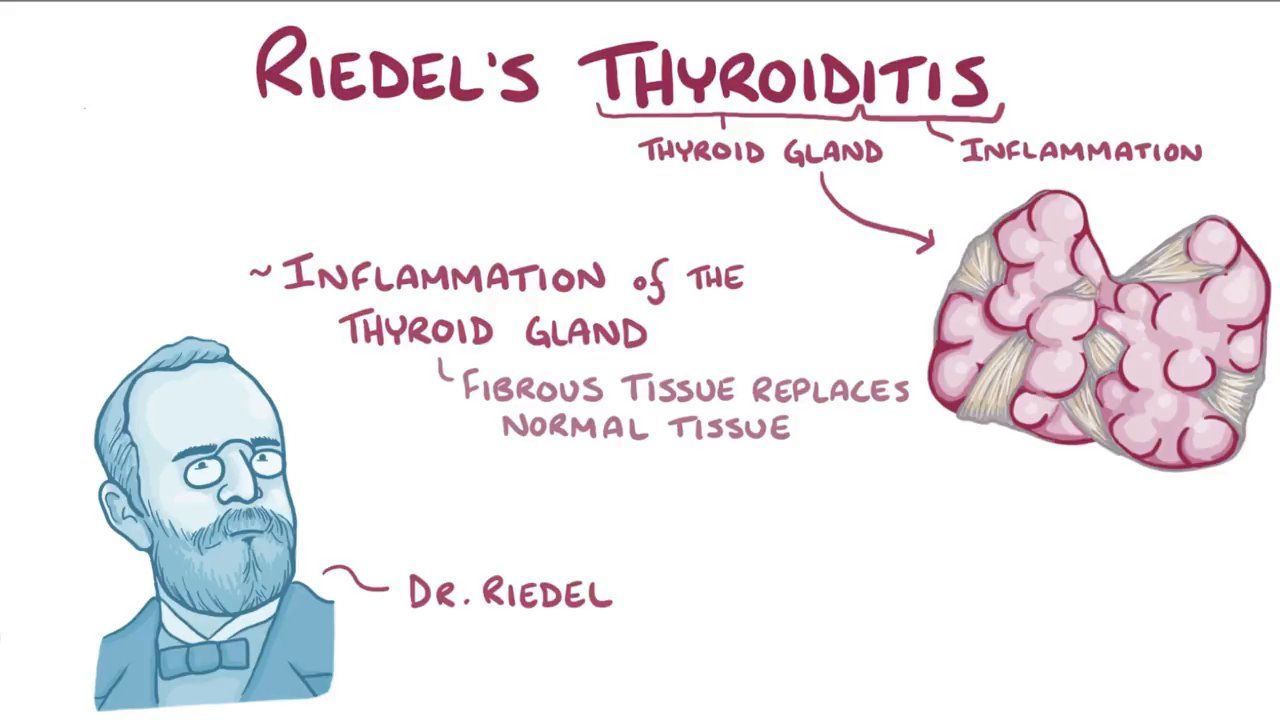 Video: Riedel thyroiditis | Osmosis