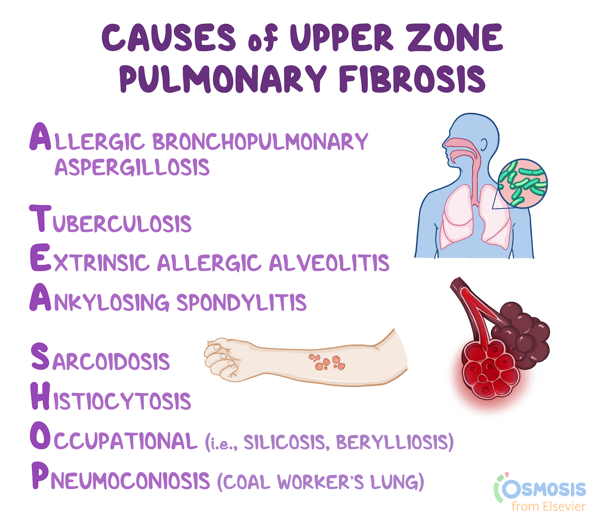 A TEA SHOP: Causes of Upper Zone Pulmonary Fibrosis Acronym | Osmosis