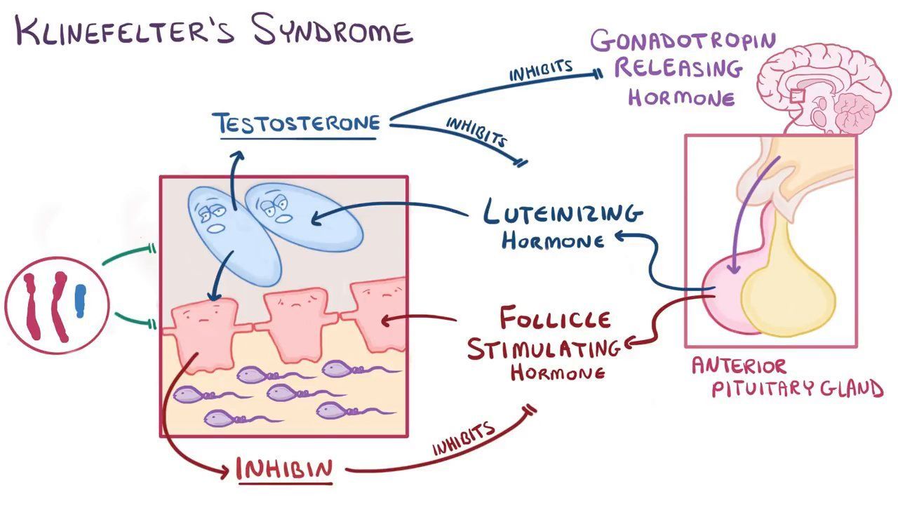 Klinefelter Syndrome. – Reports