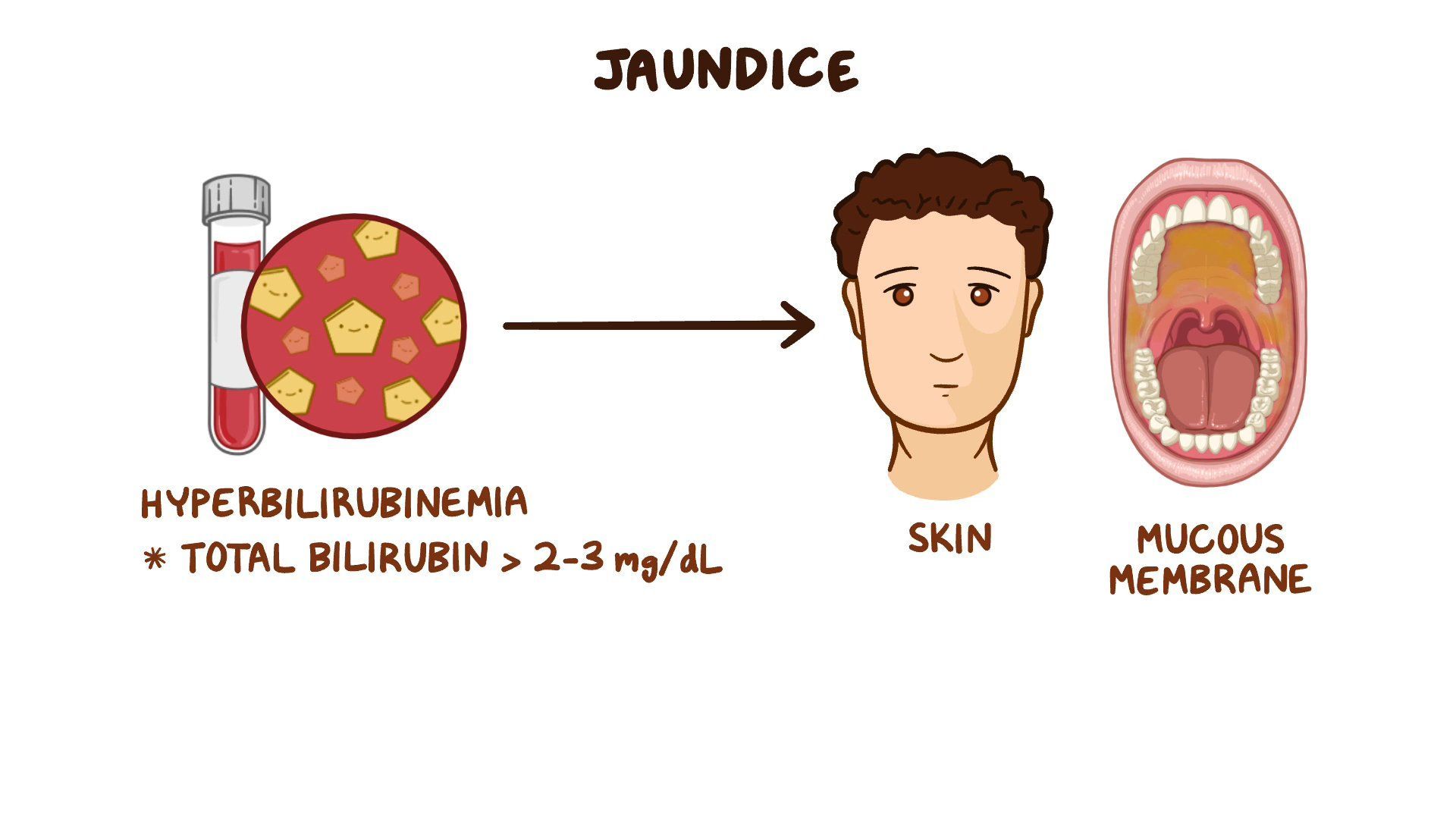 Video: Approach to jaundice (conjugated hyperbilirubinemia): Clinical ...