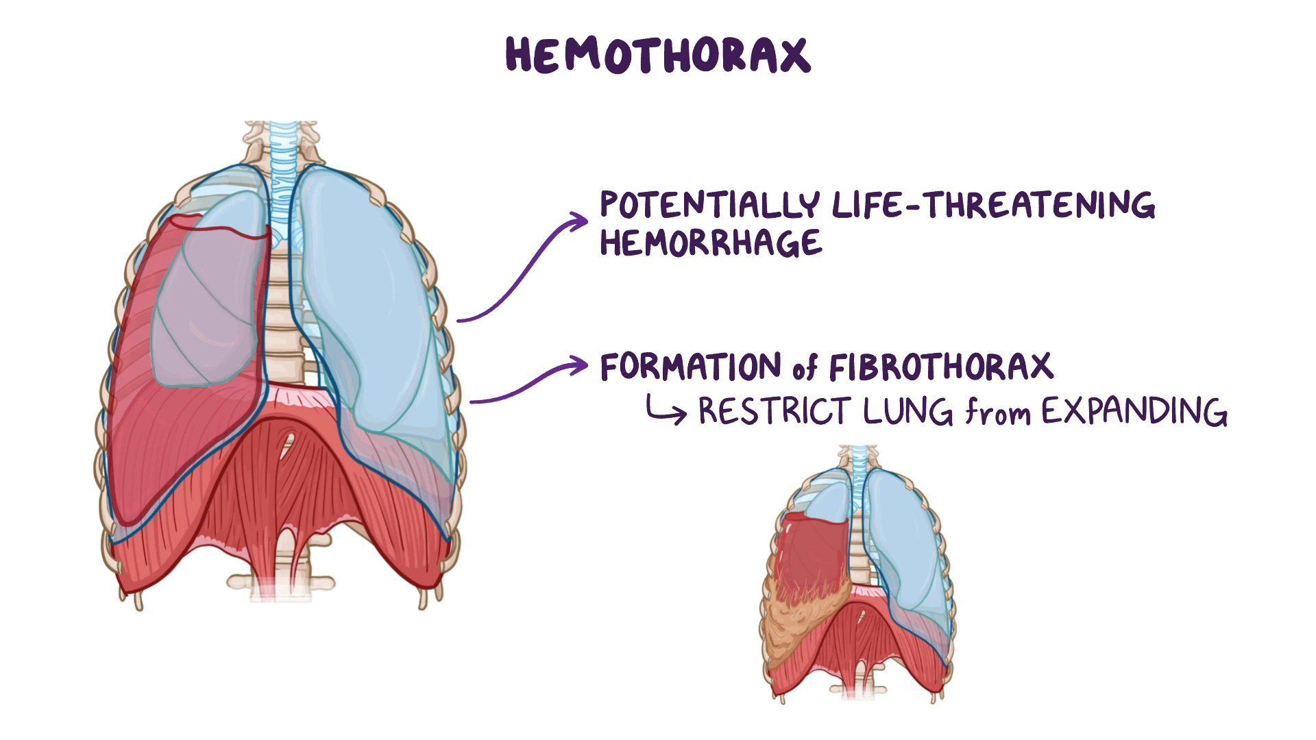 Video: Hemothorax: Clinical sciences | Osmosis