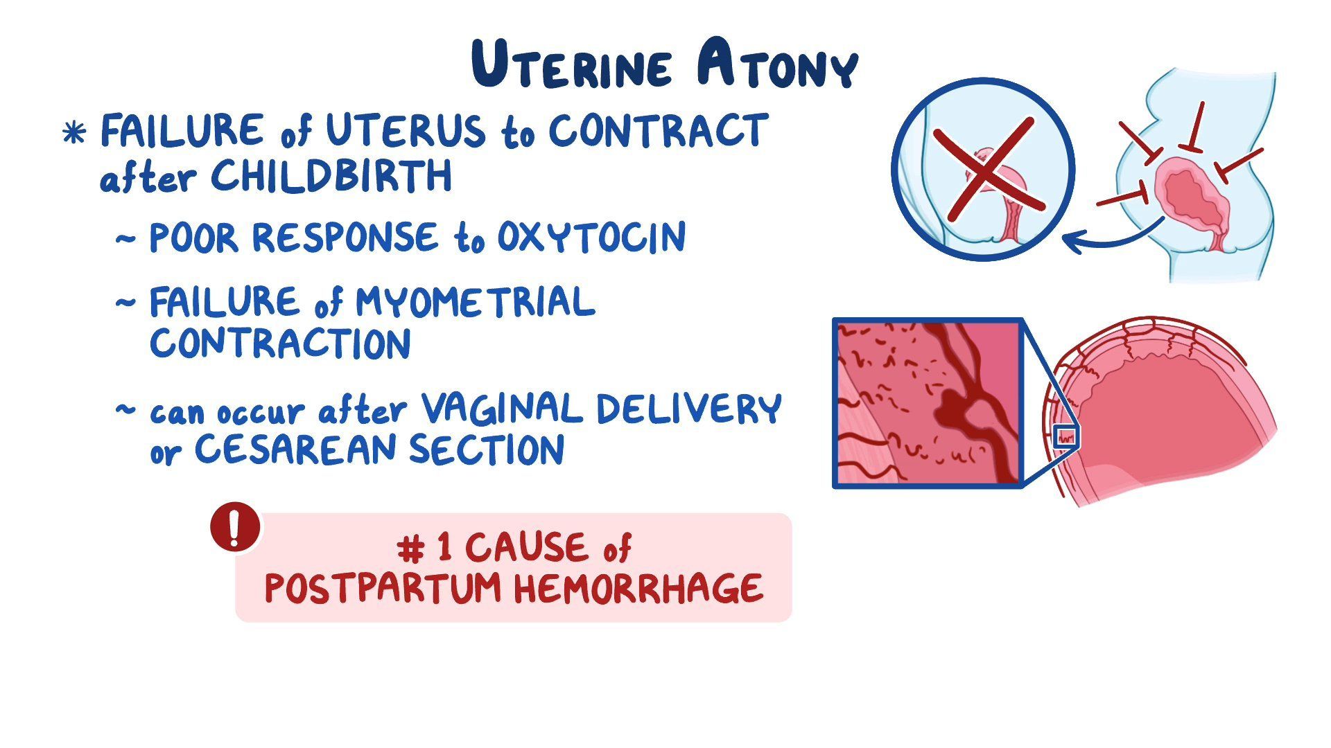 Video: Uterine atony: Clinical sciences | Osmosis