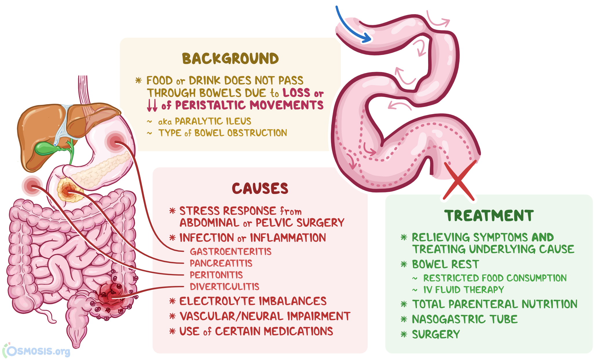Adynamic Ileus What Is It Symptoms Treatment And More Osmosis