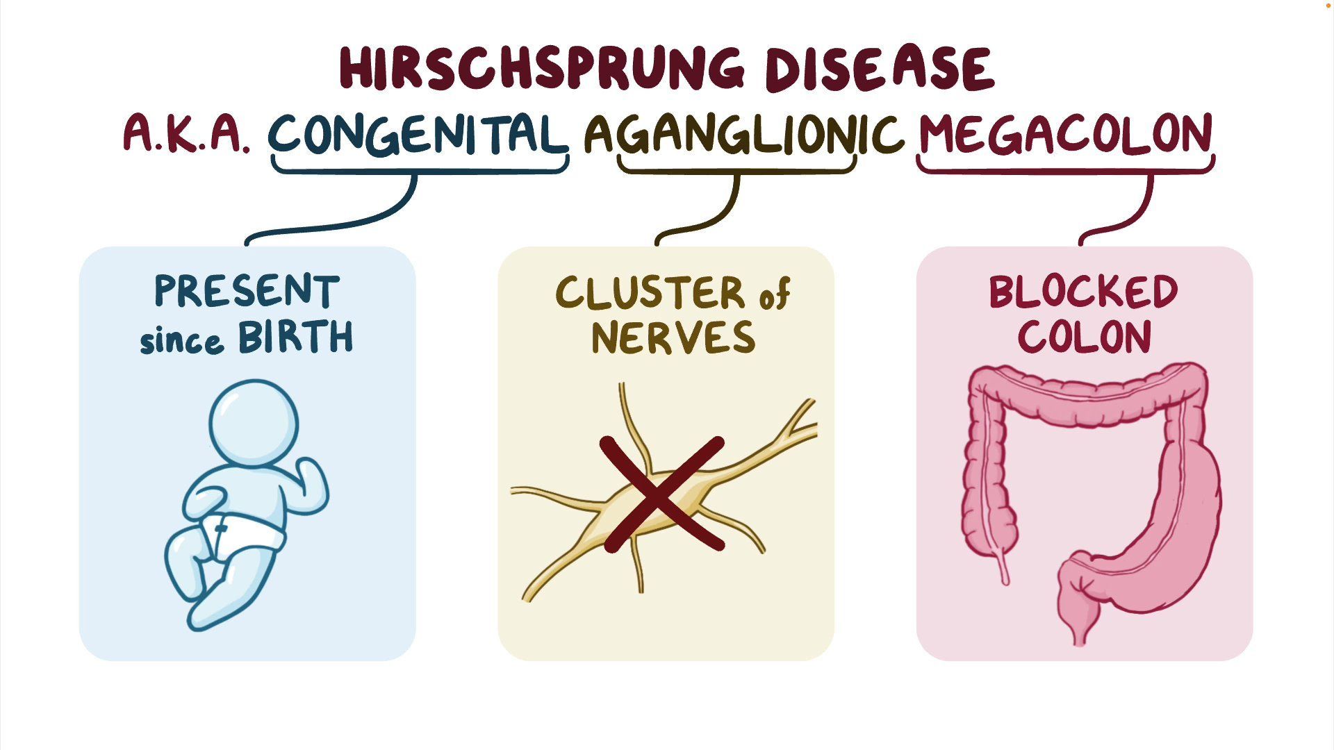 Video: Hirschsprung disease: Year of the Zebra | Osmosis