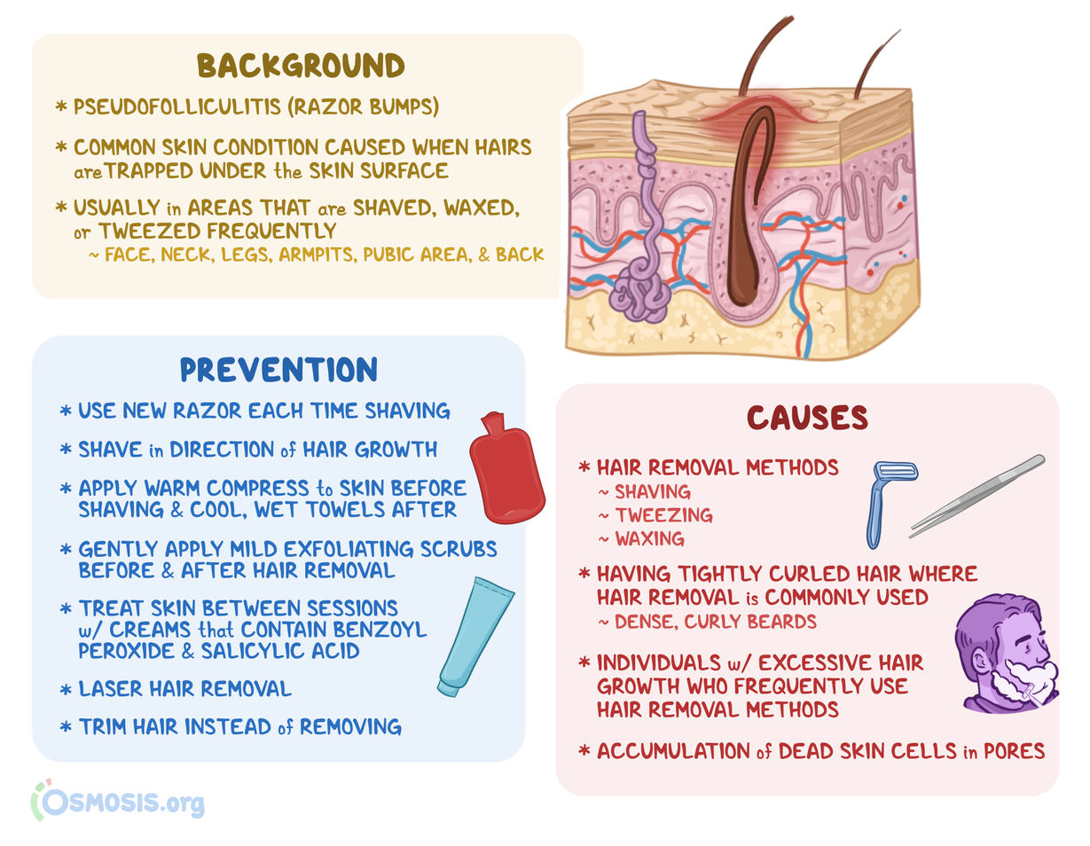 Ingrown Hair: What Is It, Treatment, Prevention, and More | Osmosis