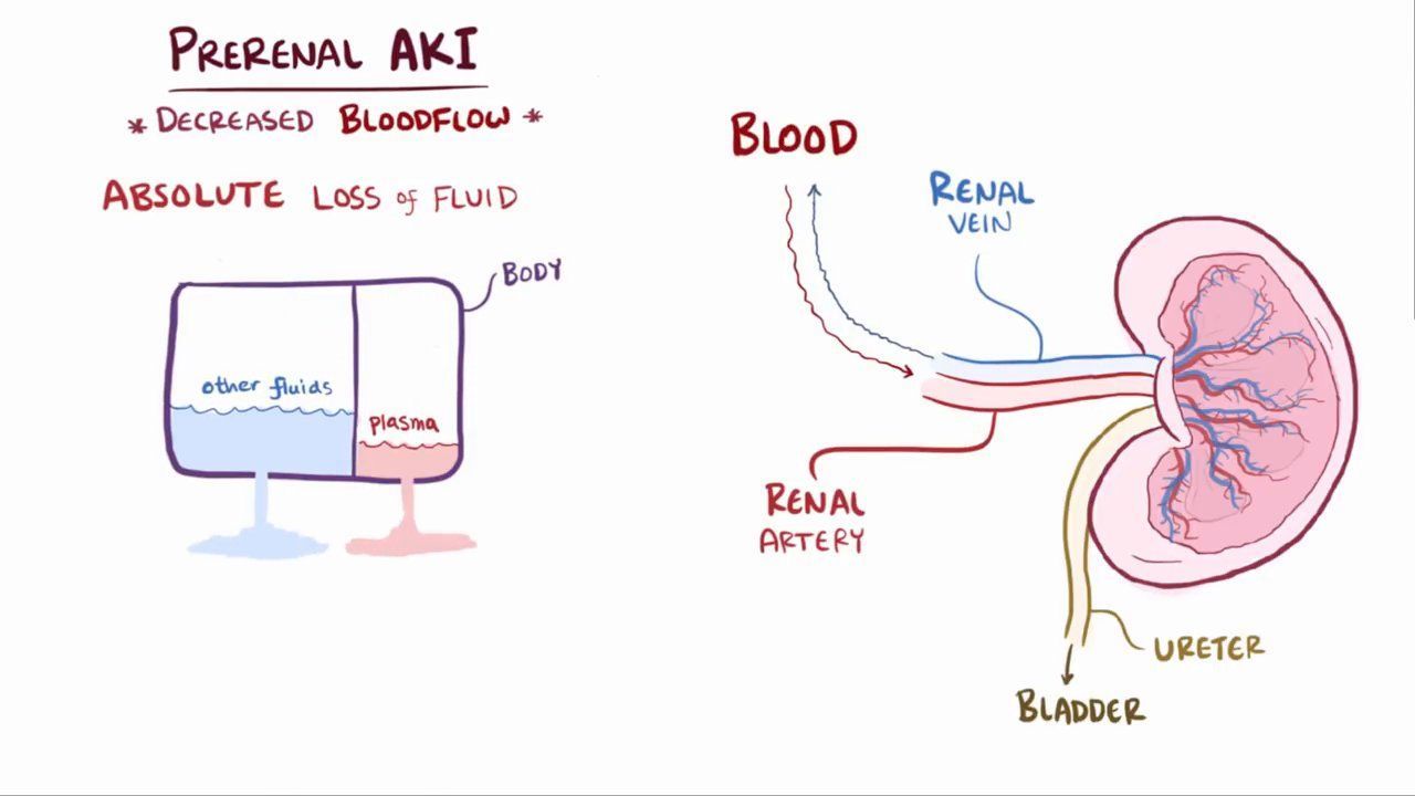 Video Prerenal Azotemia Osmosis Video Prerenal Azotemia Osmosis