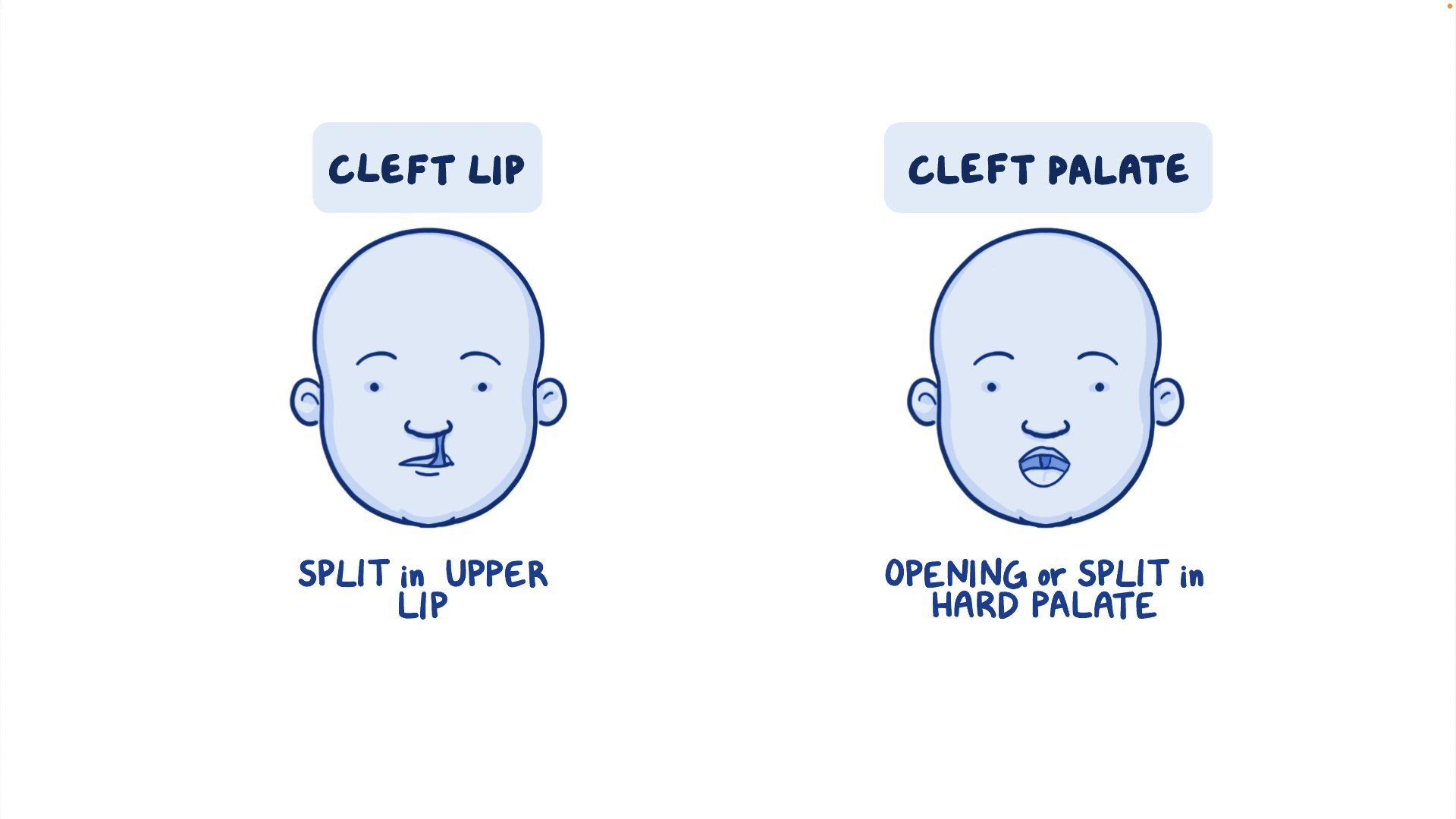 Video: Cleft lip and palate: Nursing | Osmosis