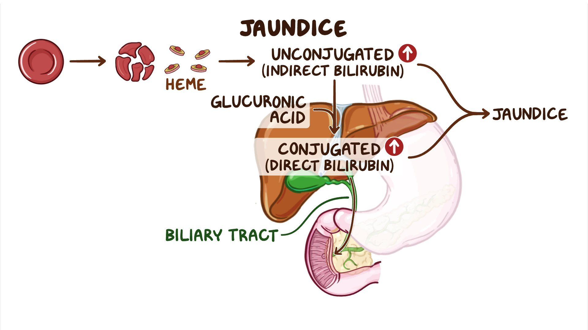 Video: Approach to jaundice (unconjugated hyperbilirubinemia): Clinical ...