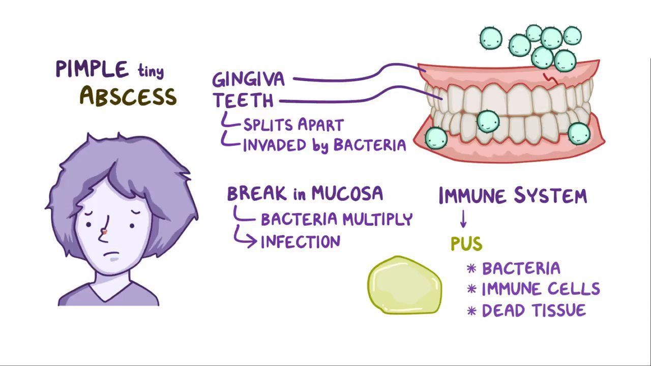 Periapical Abscess Diagram