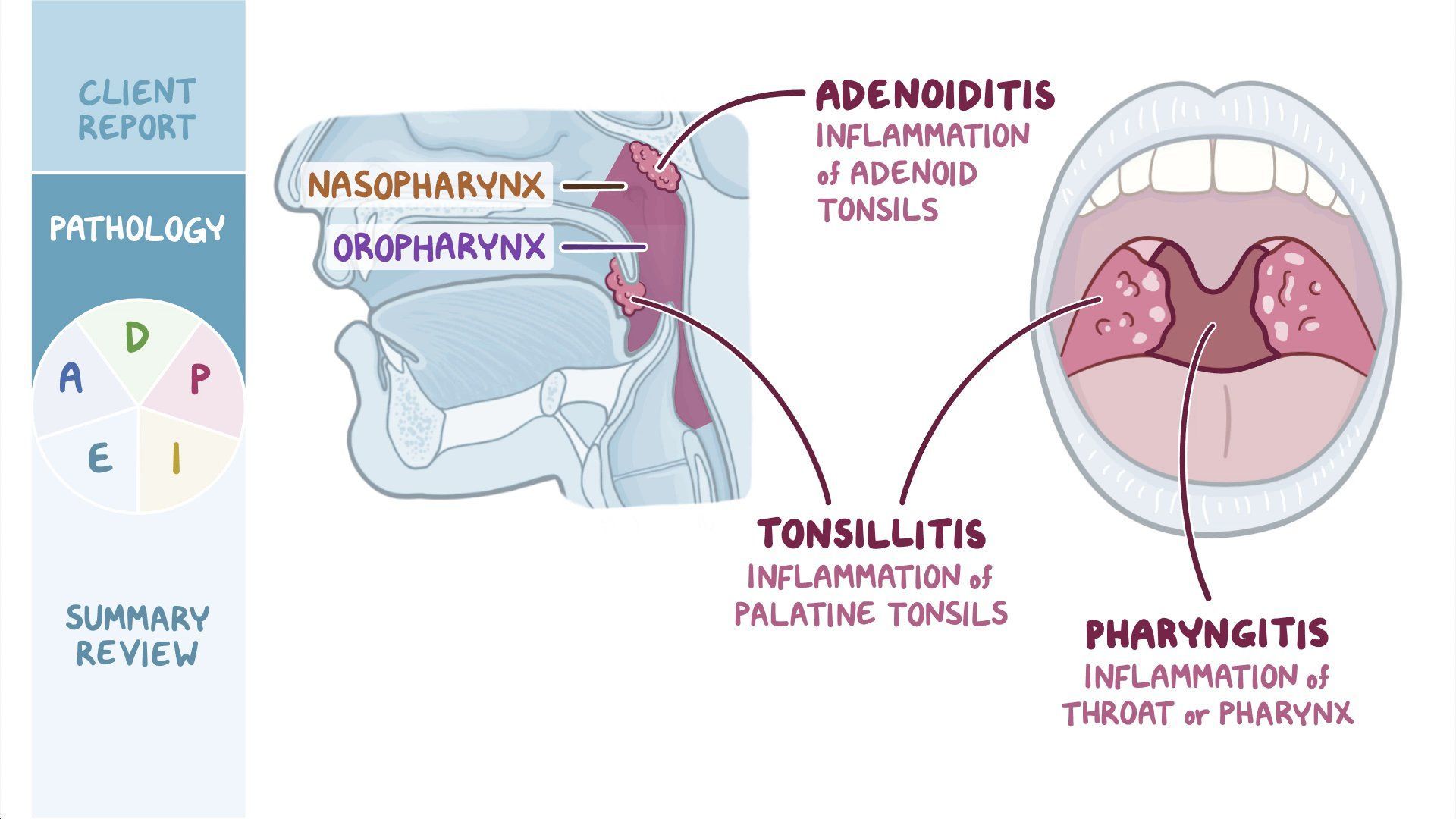 Video Tonsillitis Nursing Process ADPIE Osmosis Video Tonsillitis Nursing Process ADPIE Osmosis