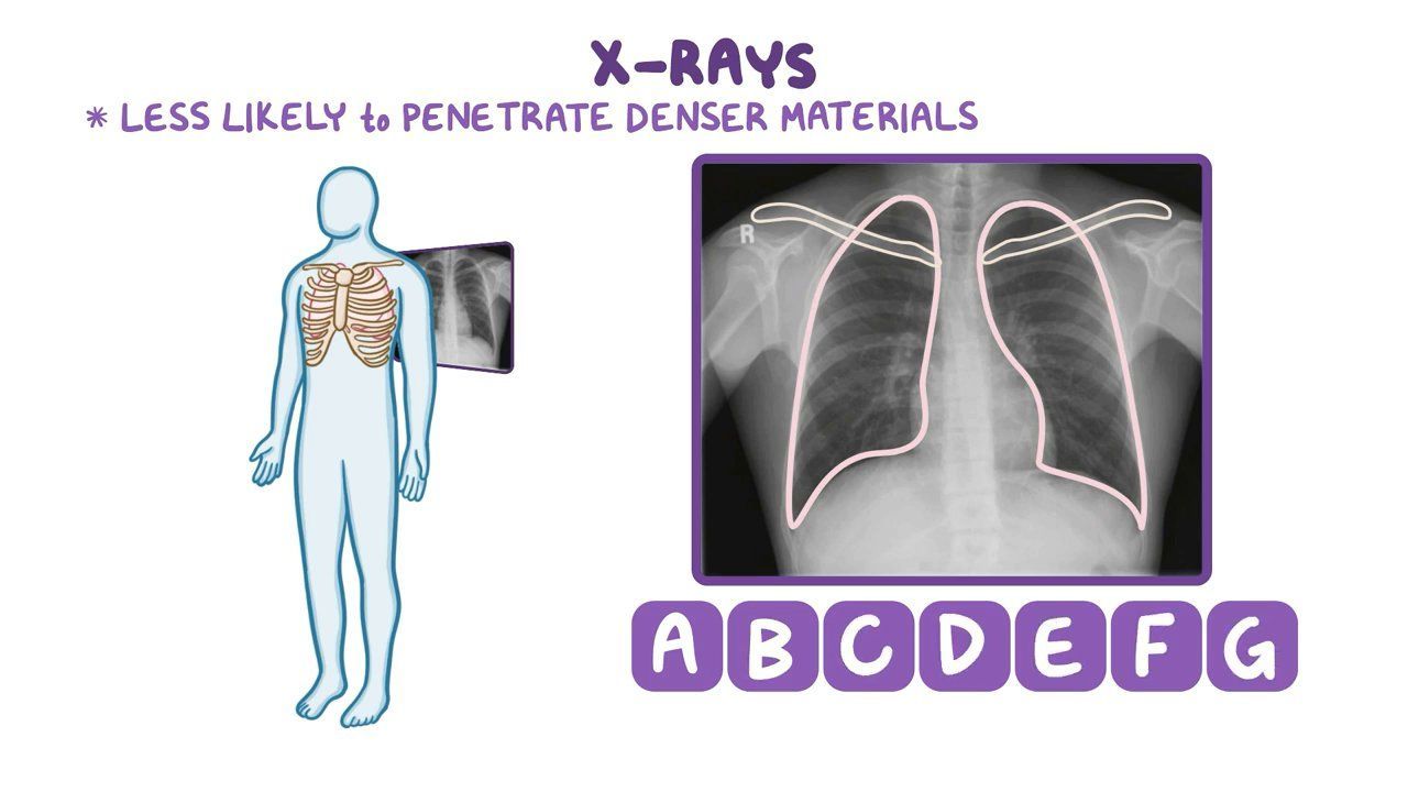 Video: Reading a chest X-ray | Osmosis