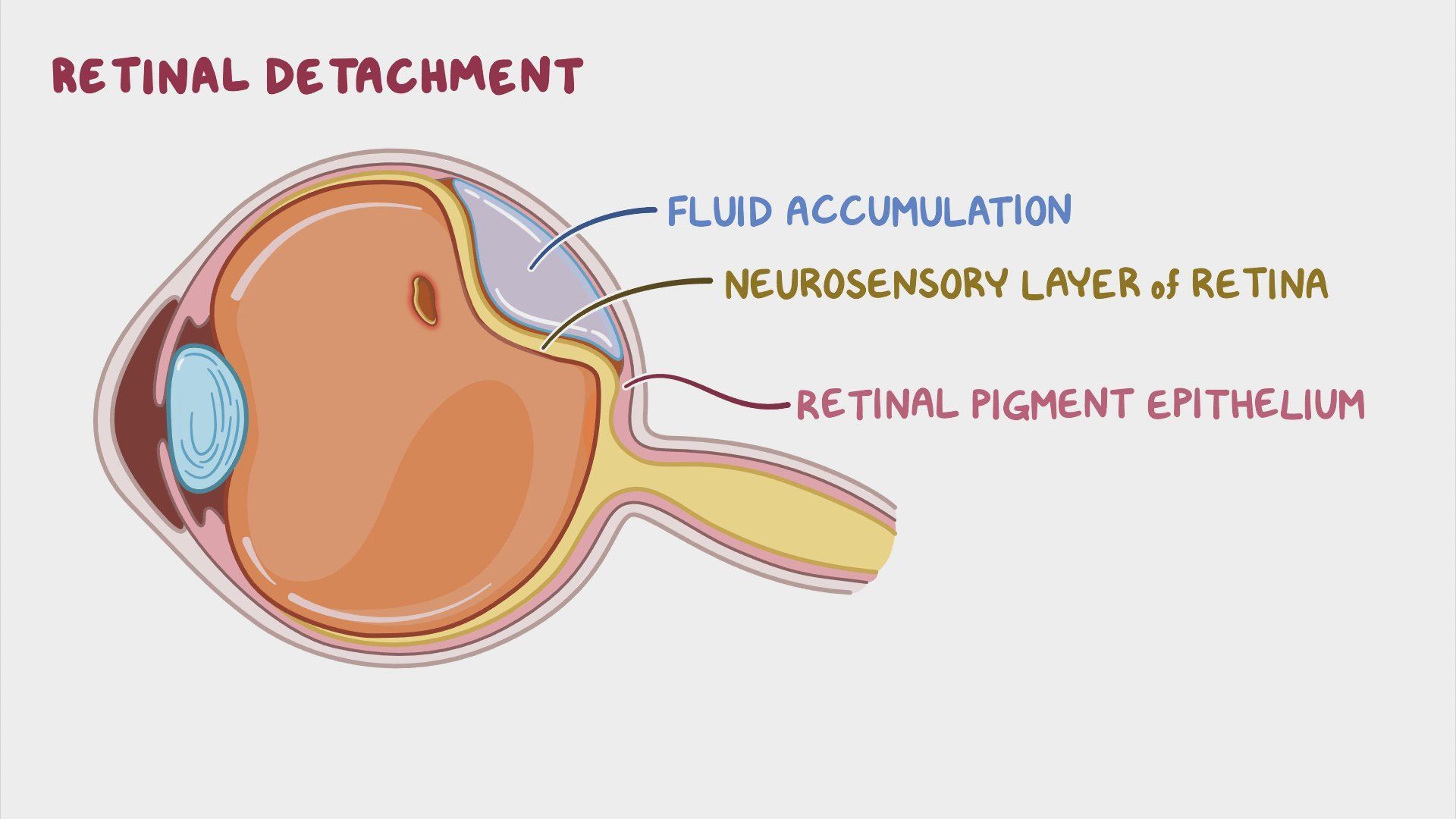 Video: Detached retina: Nursing | Osmosis
