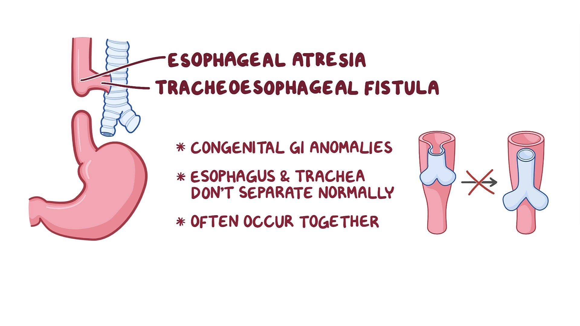 Video: Esophageal atresia and tracheoesophageal fistula: Year of the Zebra | Osmosis