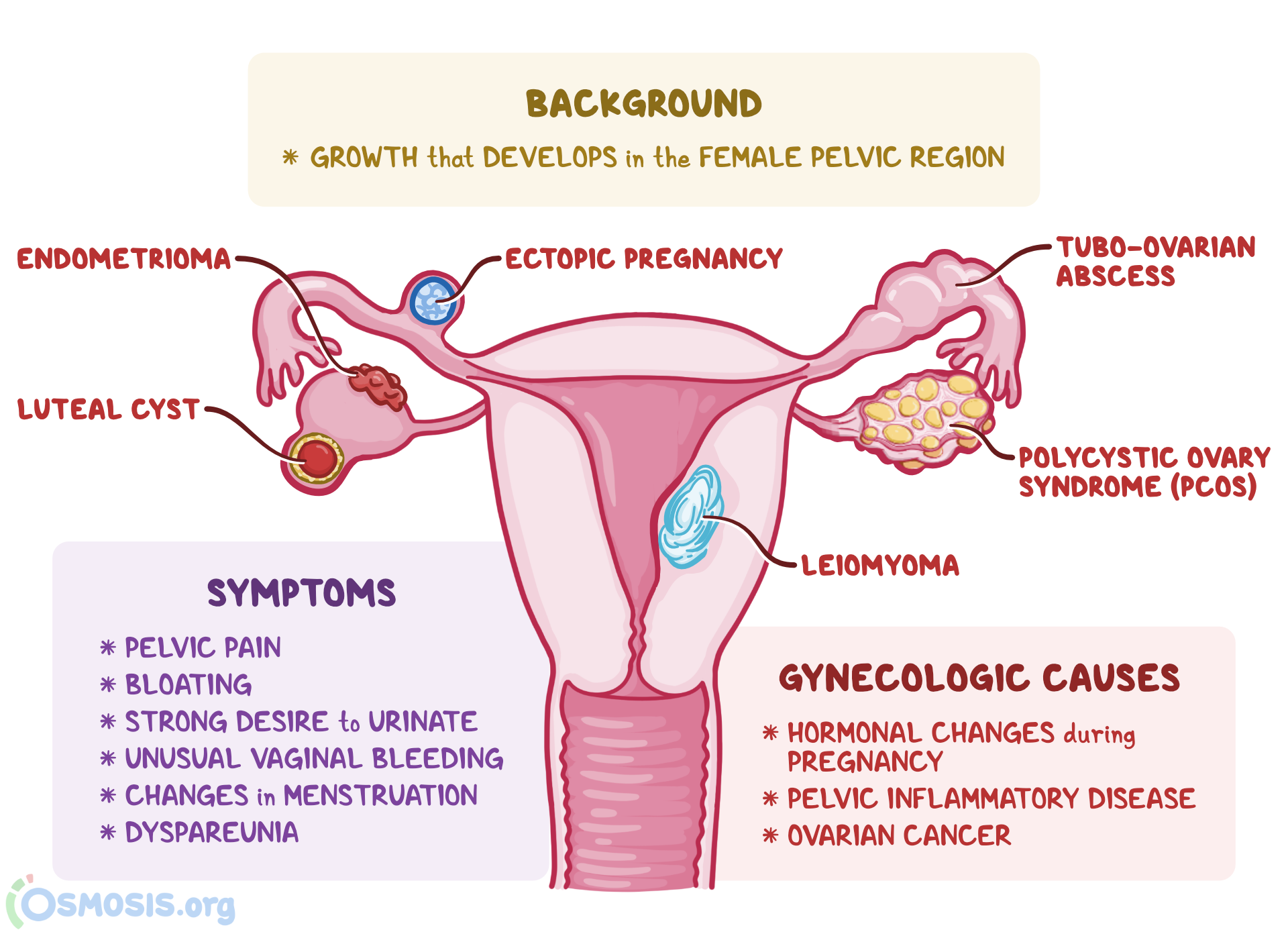 Adnexal Mass What Is It Causes Treatment And More Osmosis Adnexal Mass What Is It Causes Treatment And More Osmosis