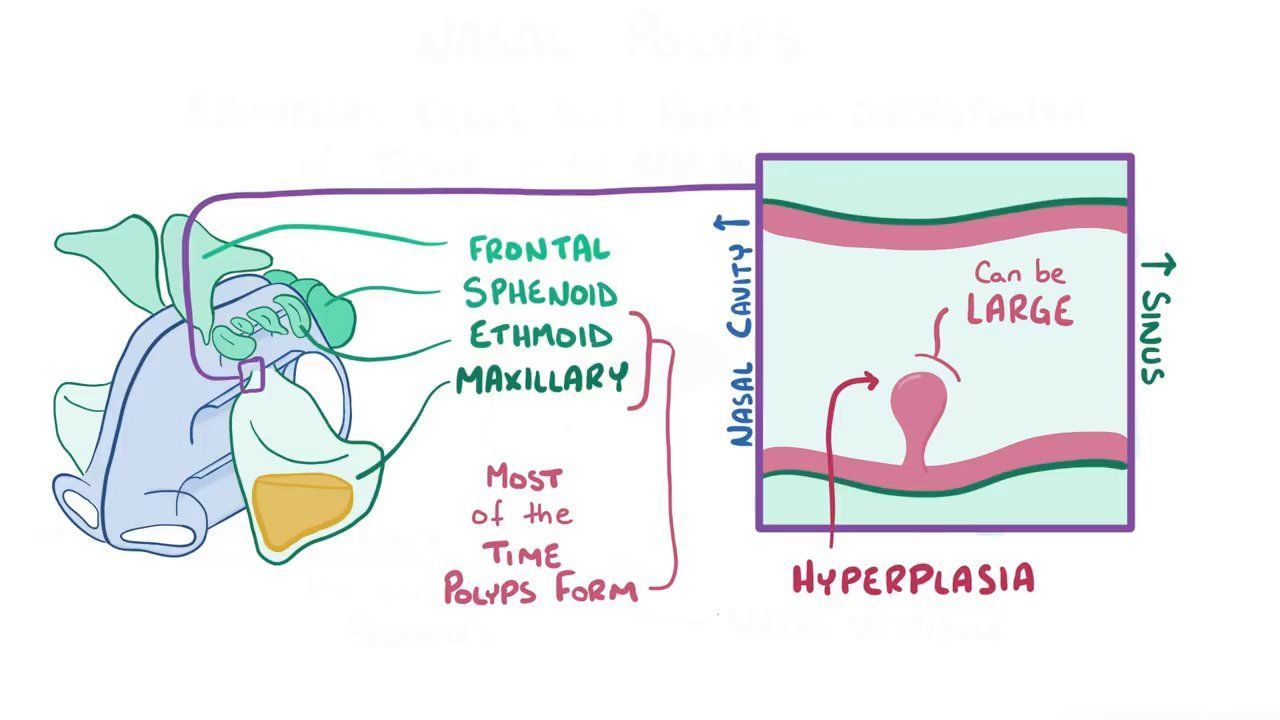 Video: Nasal polyps | Osmosis
