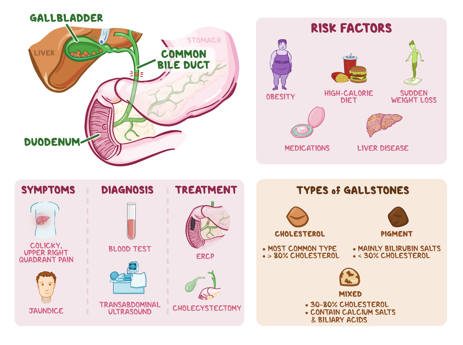 Choledocholithiasis: What Is It, Causes, Diagnosis, Treatment | Osmosis