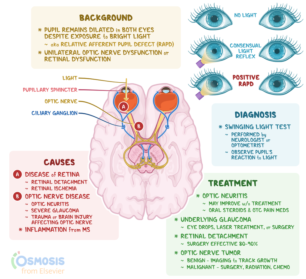 Marcus Gunn Pupil: What Is It, Causes, Treatment, and More | Osmosis