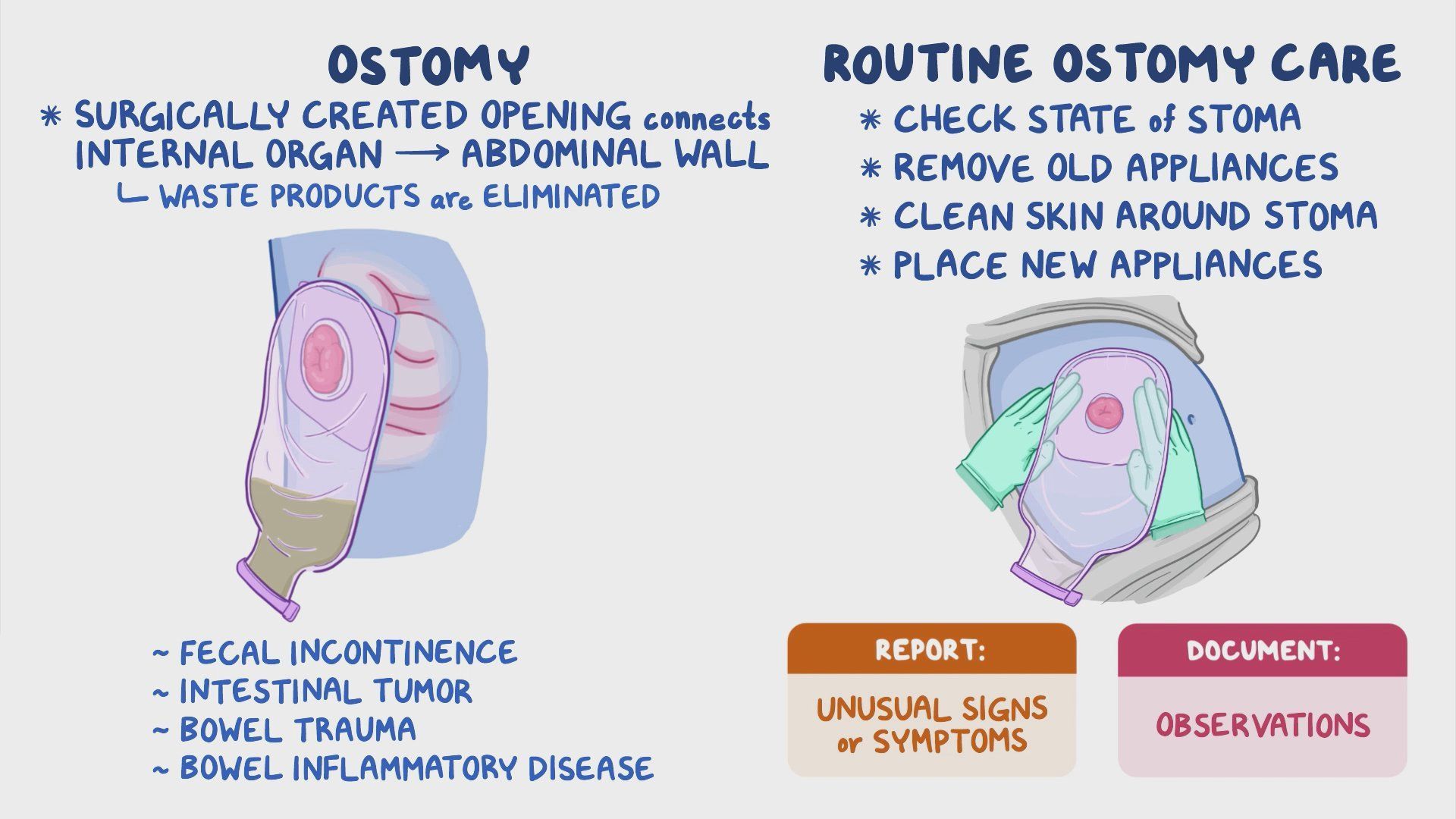 Video: GI/GU: Routine ostomy care