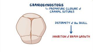 Crouzon Syndrome: What It Is, Causes, Signs and Symptoms, Treatment ...