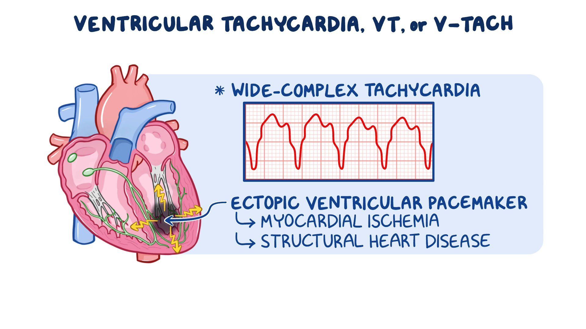 Video: Ventricular tachycardia: Clinical sciences | Osmosis