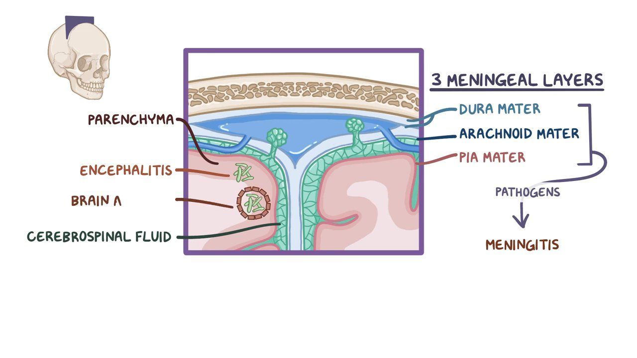 Meningitis, encephalitis and brain abscesses: Clinical practice - Osmosis
