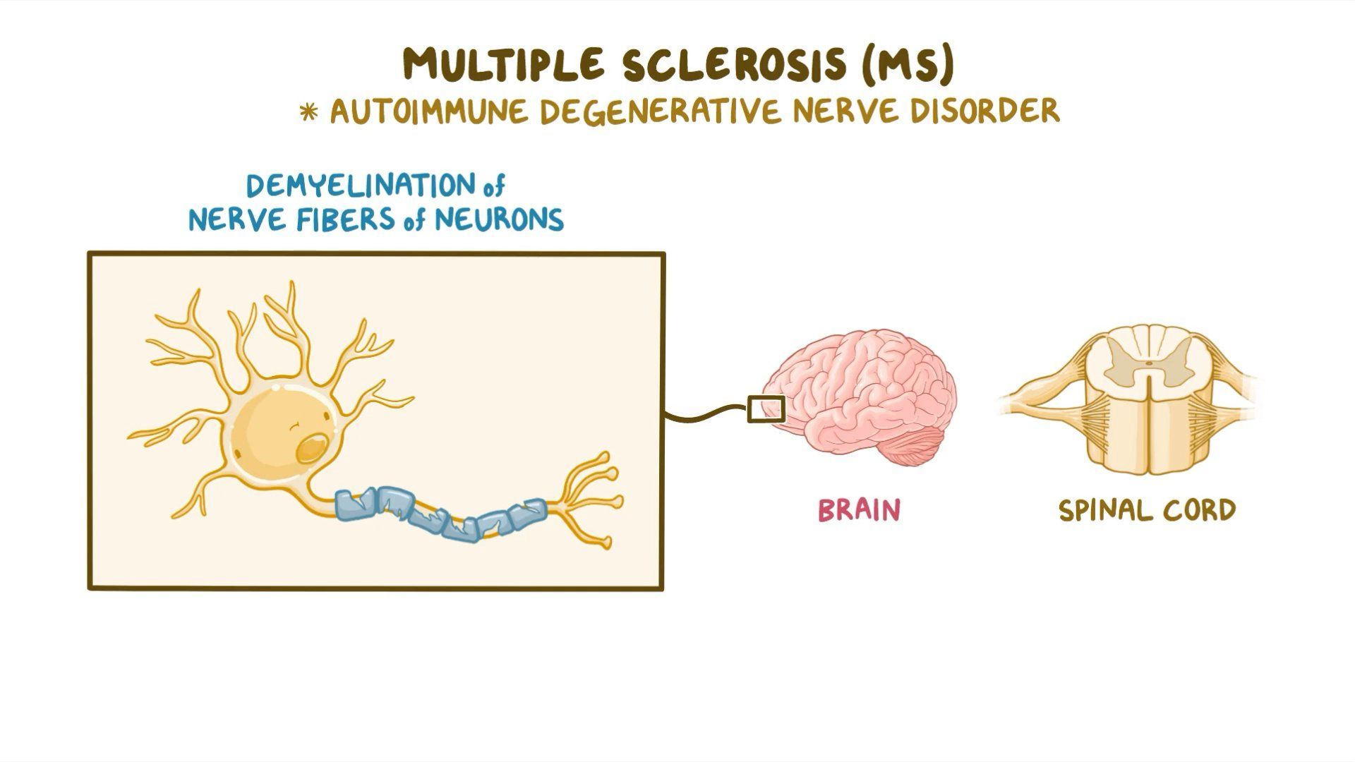 Multiple Sclerosis Autoimmune Diseases T20K Cyxone