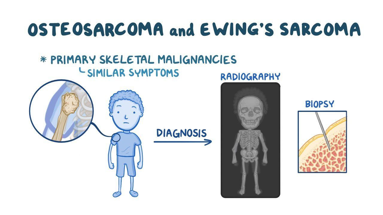 Video: Pediatric bone tumors: Clinical | Osmosis