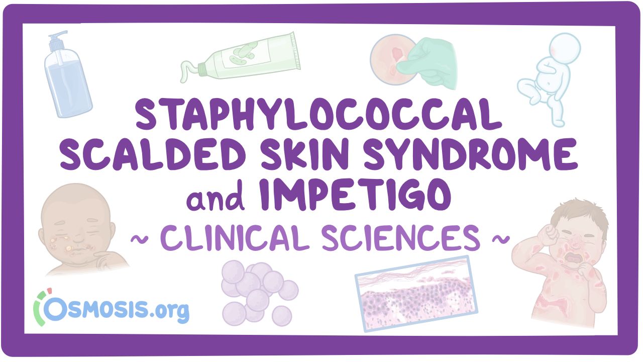 Staphylococcal Scalded Skin Syndrome Wikipedia