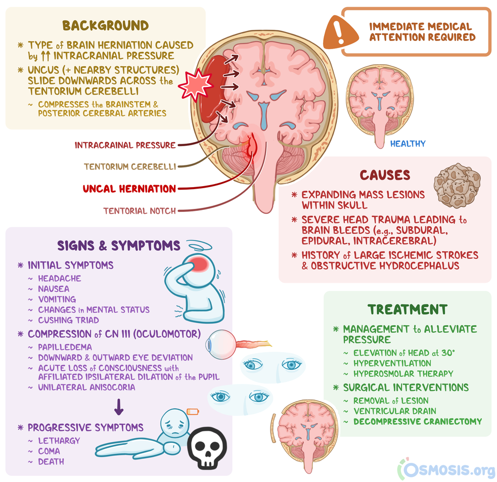 Uncal Herniation: What Is It, Causes, and More | Osmosis
