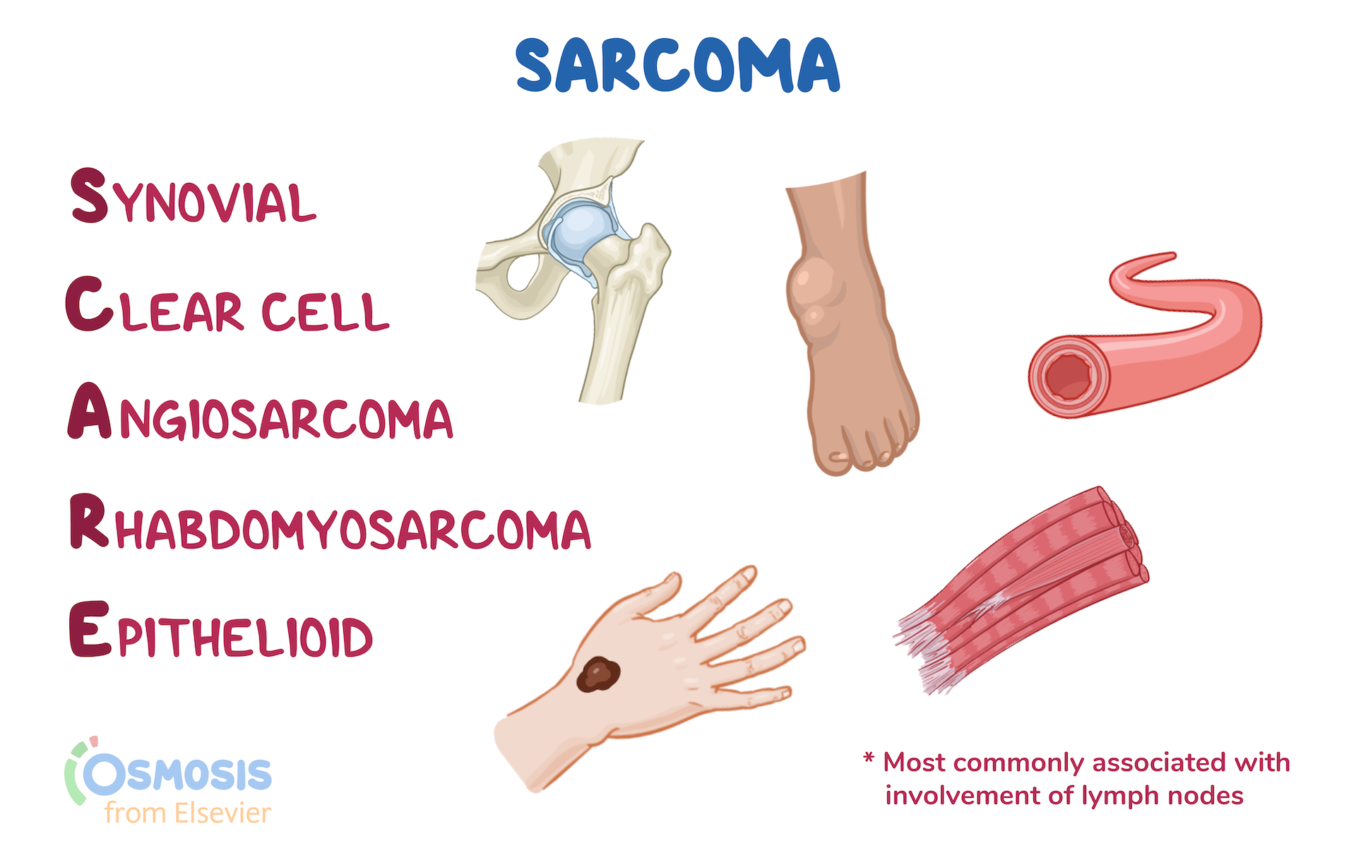 SCARE: Sarcoma Histology Acronym | Osmosis
