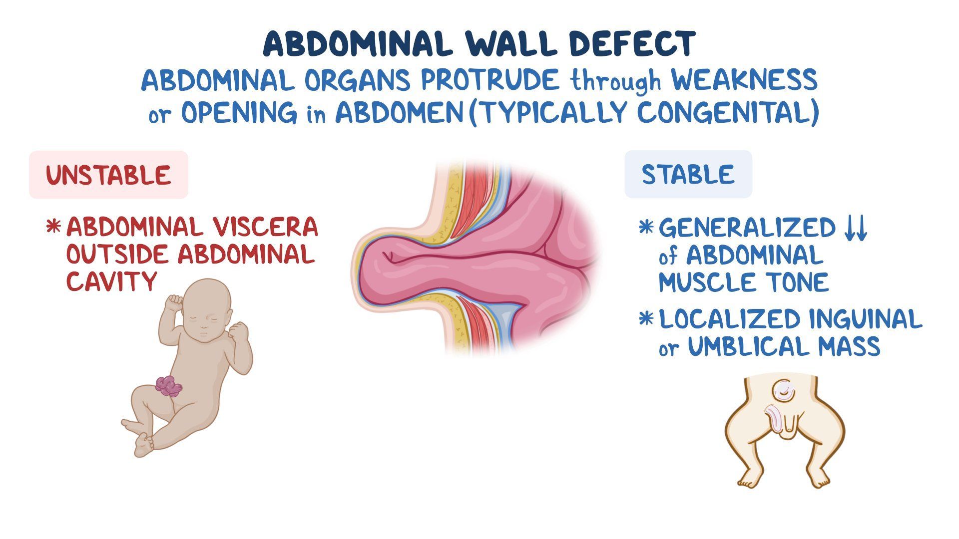 Video: Approach to abdominal wall defects: Clinical sciences