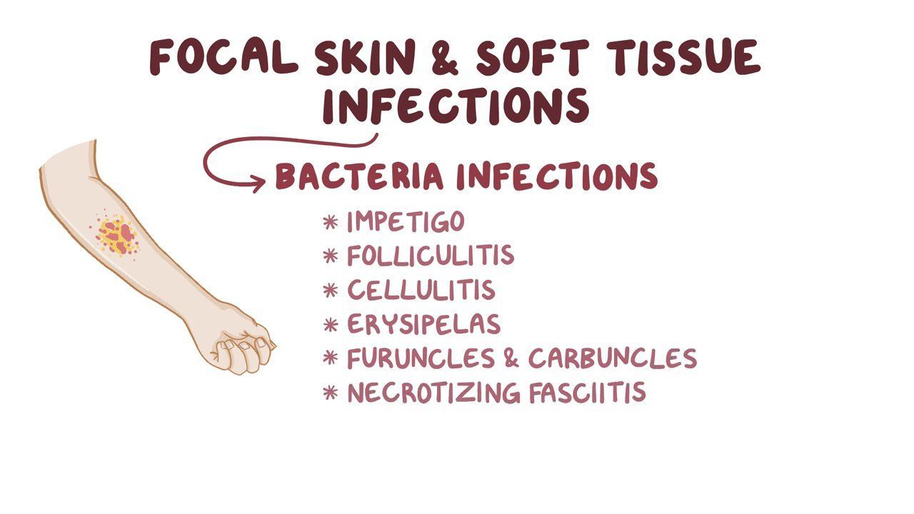 Pediatric Skin And Soft Tissue Infections Clinical Practice Osmosis