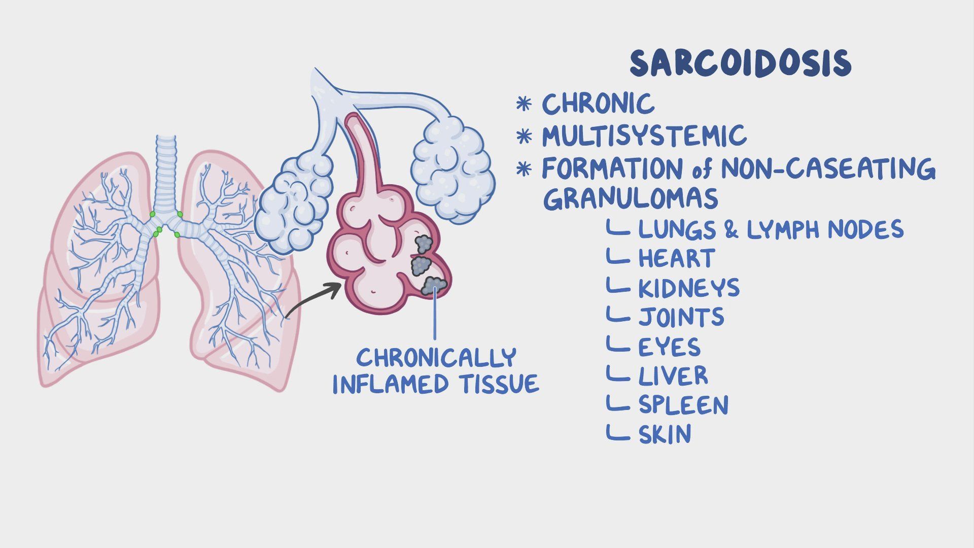 Video: Sarcoidosis: Nursing | Osmosis