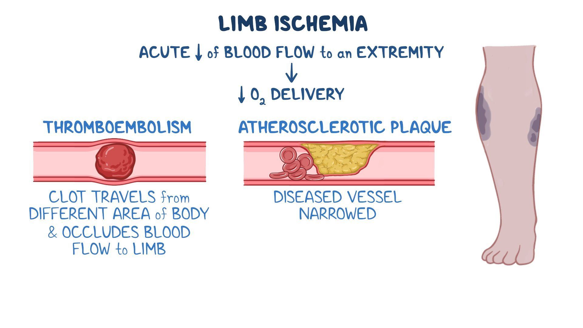 Video: Acute limb ischemia: Clinical sciences | Osmosis
