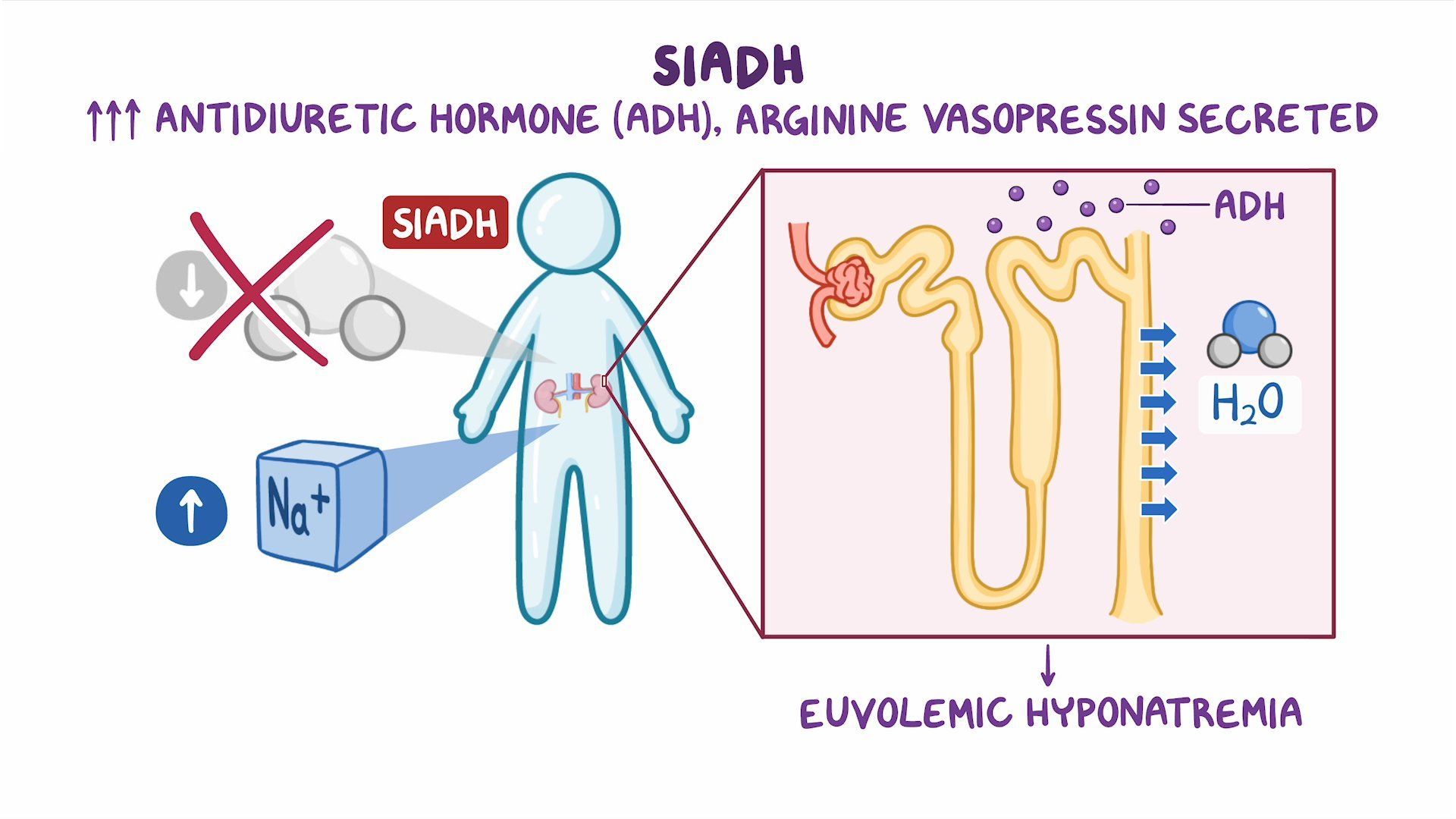 Antidiuretic Hormone Syndrome Of Inappropriate Antidiuresis